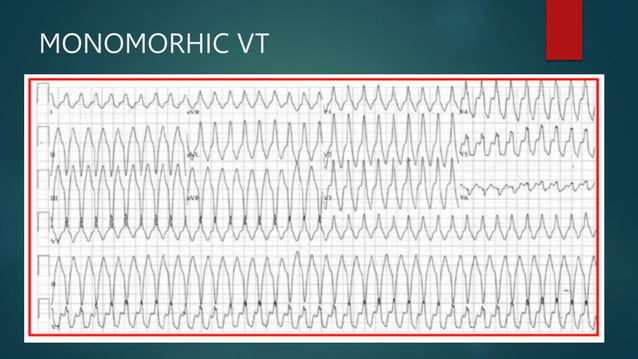 DIFFERENTIALS OF ARRYTHMIAS WITH RBBB MORPHOLOGY.pptx