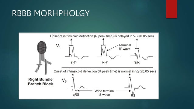 DIFFERENTIALS OF ARRYTHMIAS WITH RBBB MORPHOLOGY.pptx