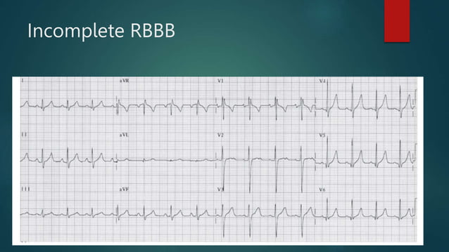 DIFFERENTIALS OF ARRYTHMIAS WITH RBBB MORPHOLOGY.pptx