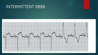 DIFFERENTIALS OF ARRYTHMIAS WITH RBBB MORPHOLOGY.pptx
