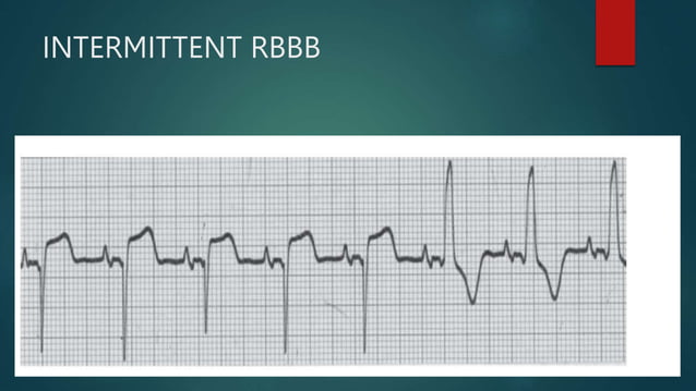 DIFFERENTIALS OF ARRYTHMIAS WITH RBBB MORPHOLOGY.pptx