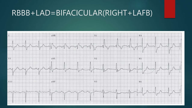 DIFFERENTIALS OF ARRYTHMIAS WITH RBBB MORPHOLOGY.pptx