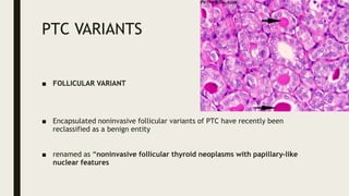 DIFFERENTIAL THYROID CARCINOMA | PPT