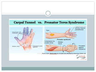 Pronator Teres Syndrome