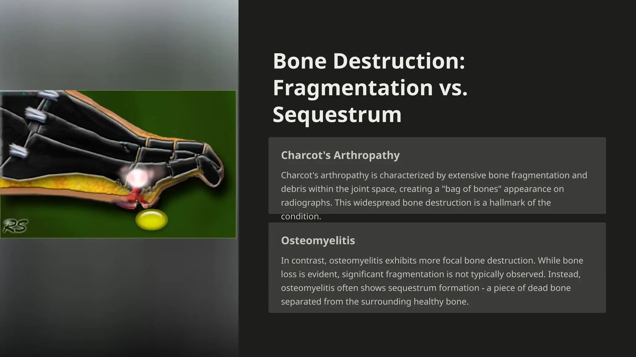 Differentiating-Charcots-Arthropathy-from-Osteomyelitis PPT.pptx