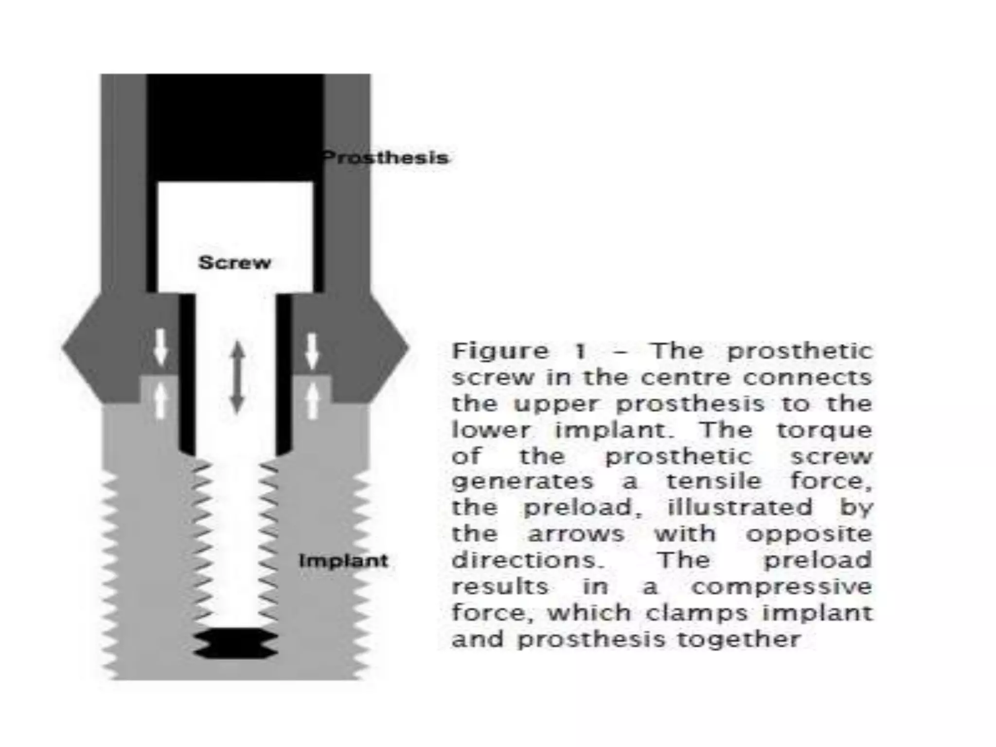 Different implant abutment connections | PPTX
