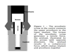 Different implant abutment connections | PPTX