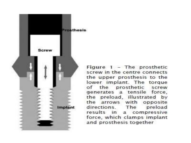 Different implant abutment connections | PPTX | Dental Health ...