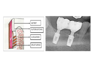 Different implant abutment connections | PPTX