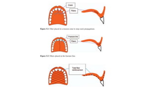 Different materials used in denture base reinforcement in case of ...