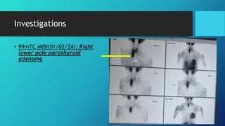 Different scenarios of managing Parathyroid adenoma.pdf