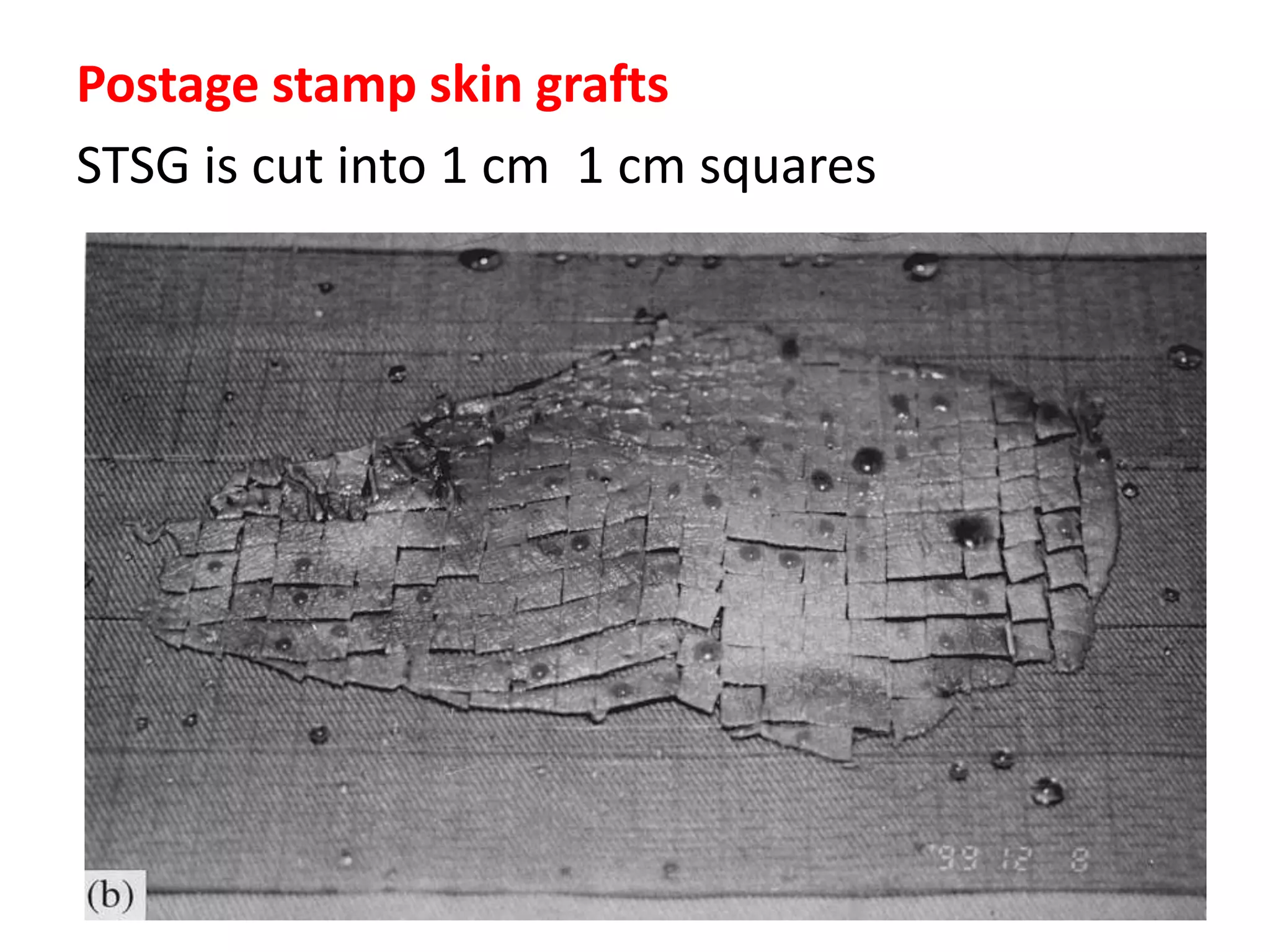 Different technique in skin grafting | PPTX