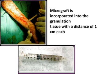 Different technique in skin grafting | PPTX