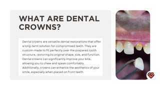 Understanding Different Type of Dental Crowns.pptx