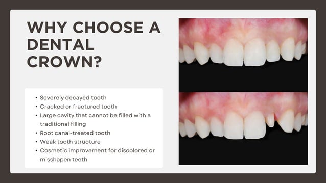 Understanding Different Type of Dental Crowns.pptx