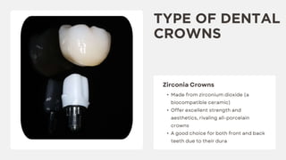 Understanding Different Type of Dental Crowns.pptx