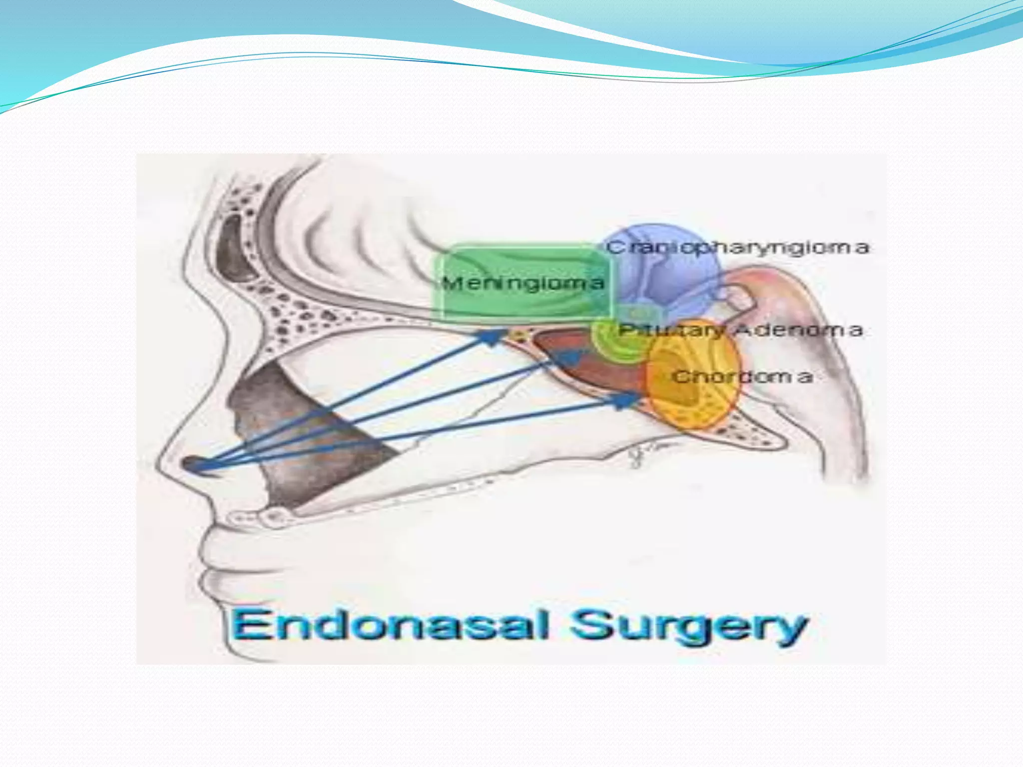 Different Types of Brain Surgery | PPTX