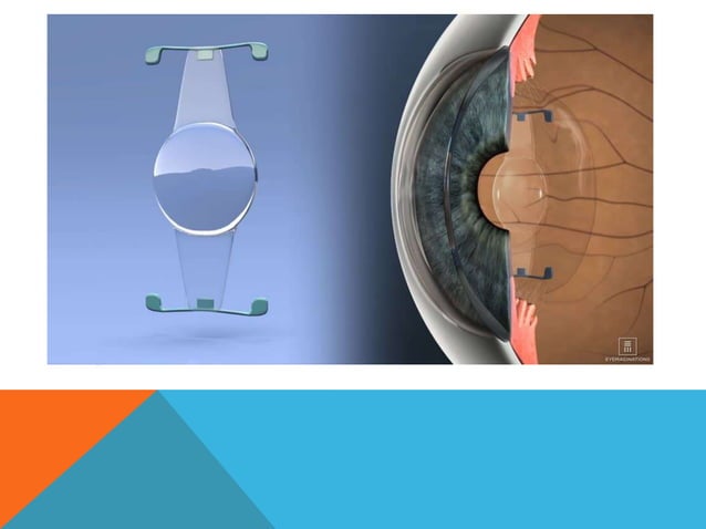DIFFERENT TYPES OF CATARACT LENSES.pptx