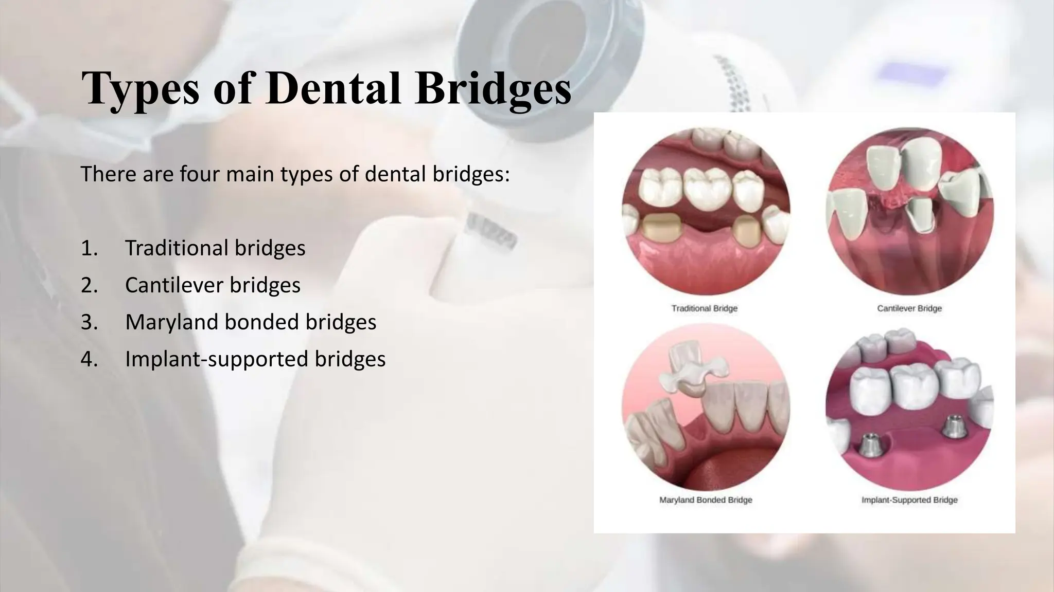 Different Types of Dental bridges - Green Valley Smile Care.pptx