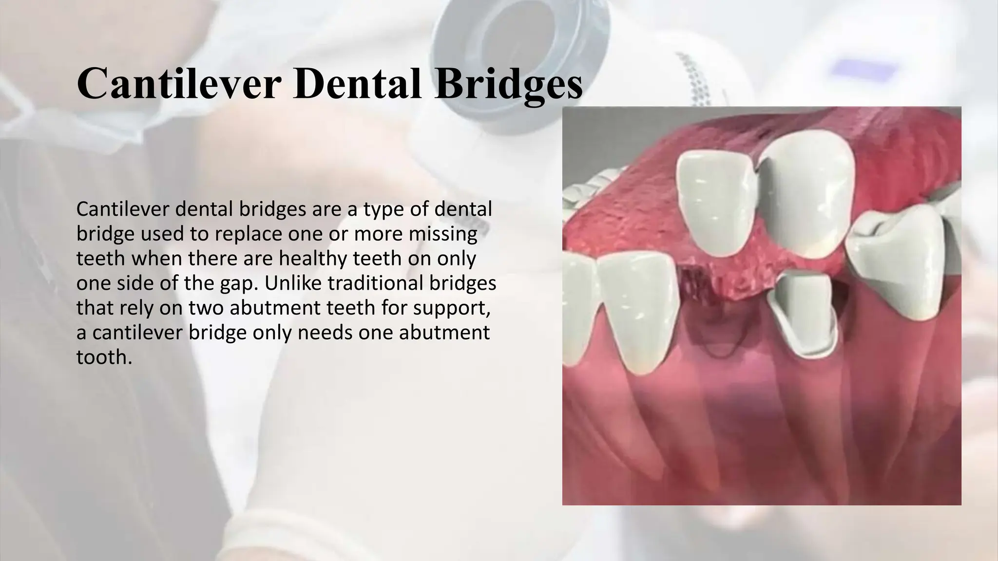 Different Types of Dental bridges - Green Valley Smile Care.pptx