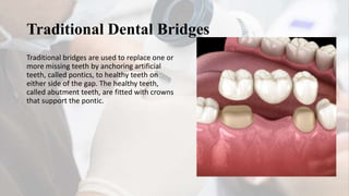 Different Types of Dental bridges - Green Valley Smile Care.pptx