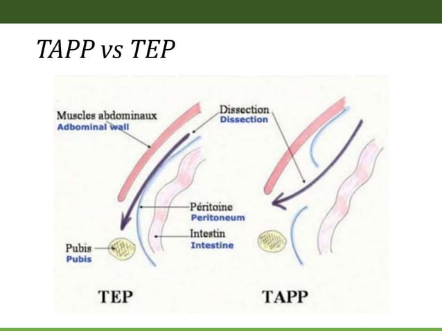 Different types of laparoscopic hernia repair