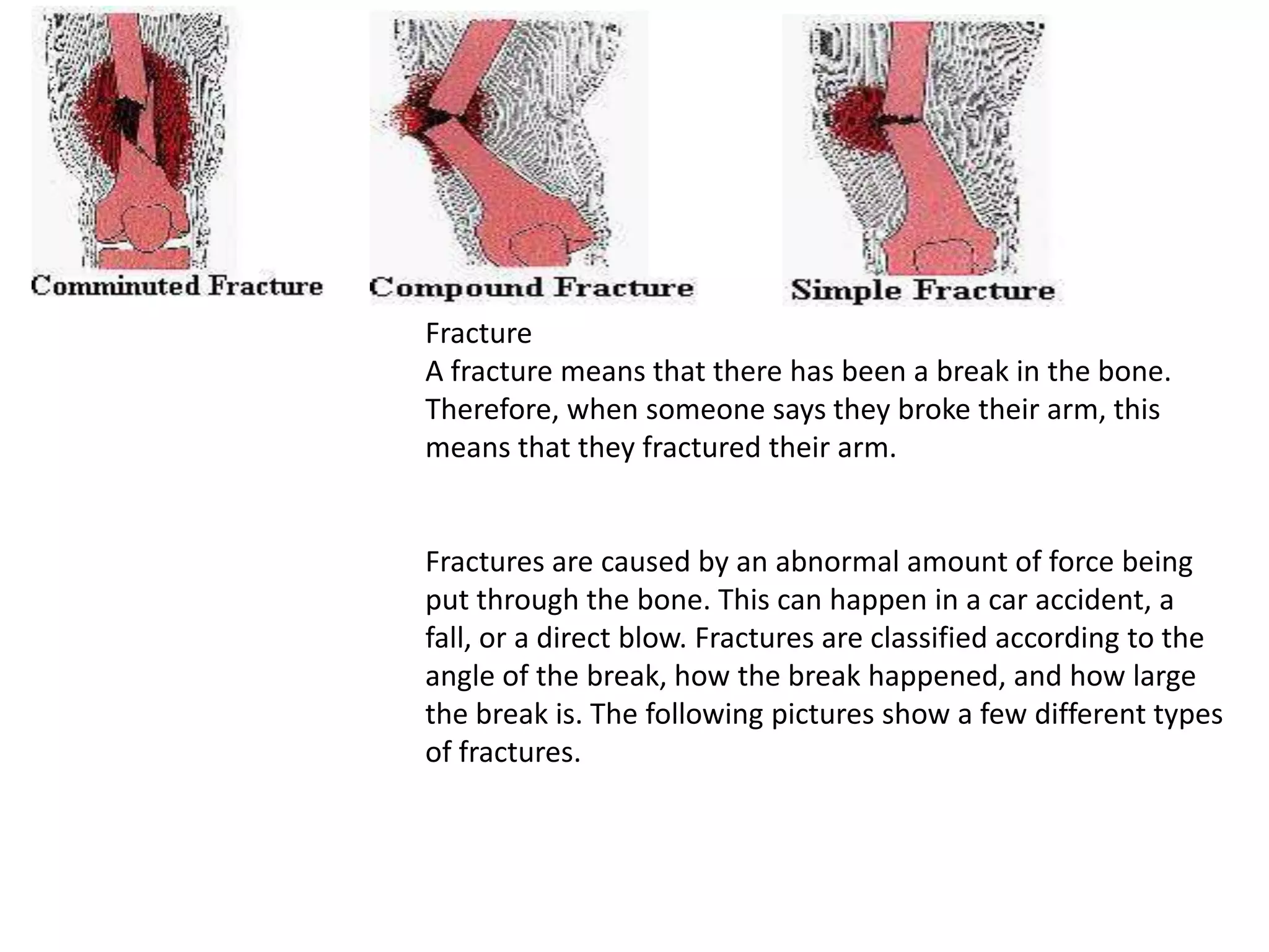 Different types of painful fractures | PPTX