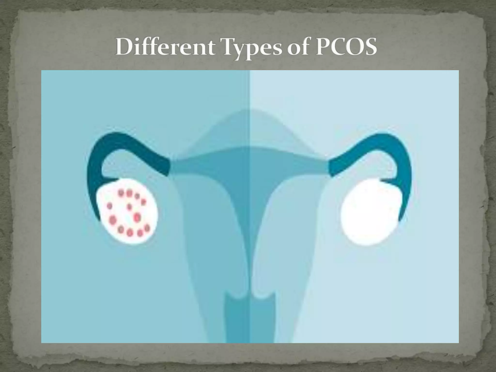 Types of PCOS | PPTX