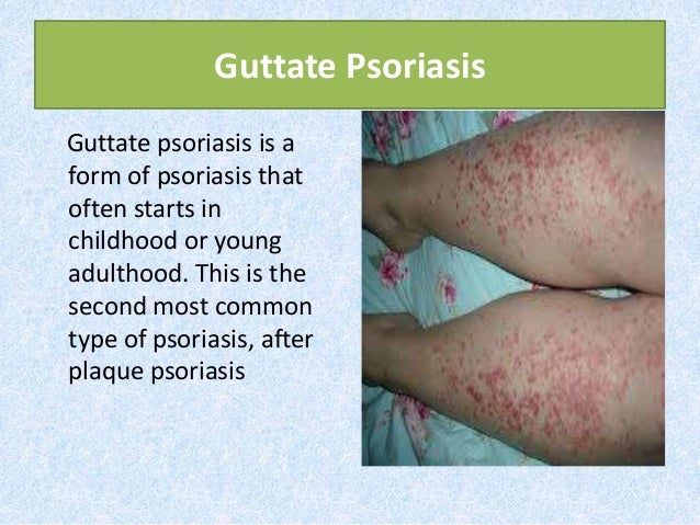 Different Types Of Psoriasis