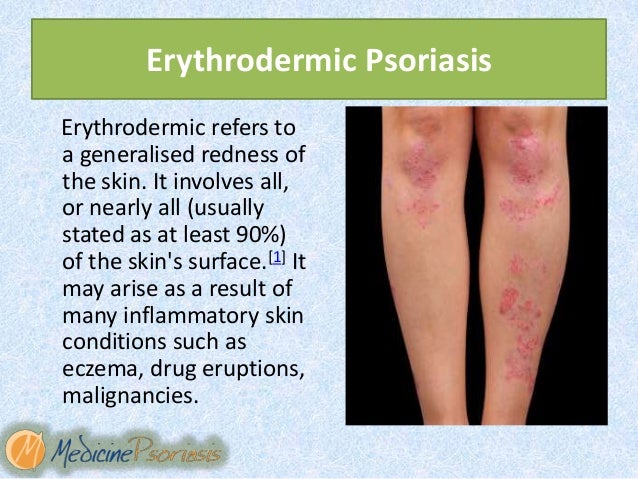 Different Types Of Psoriasis