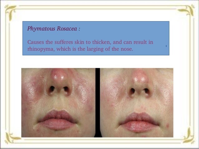 Different Types Of Rosacea Symptoms