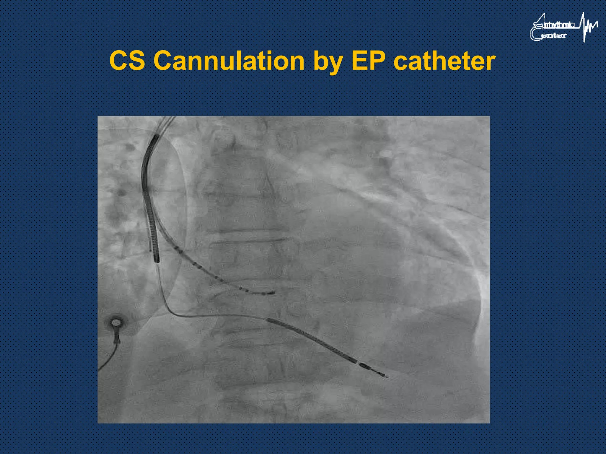 Difficult Coronary Sinus Lead Implantation | PPTX