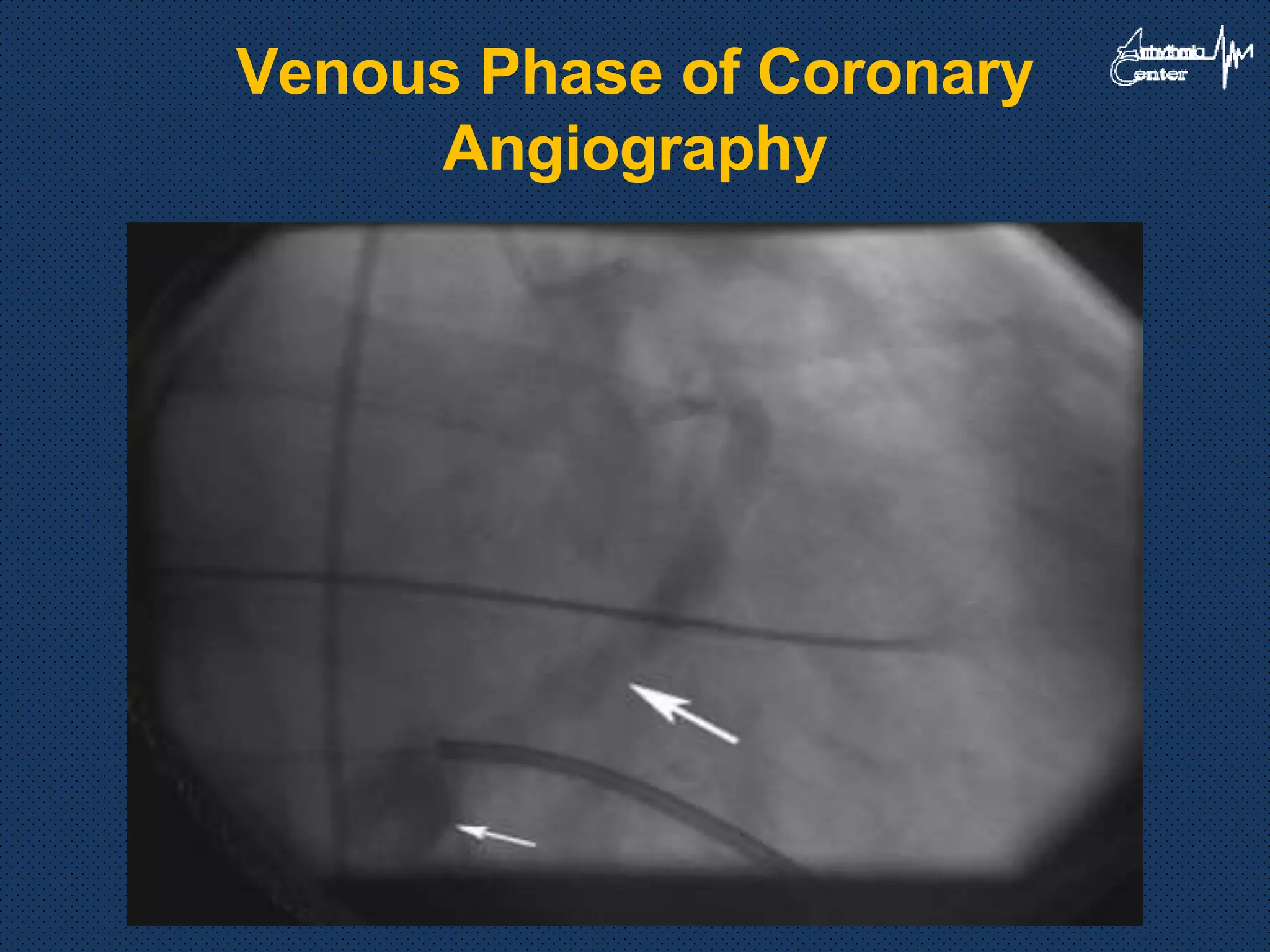 Difficult Coronary Sinus Lead Implantation | PPTX
