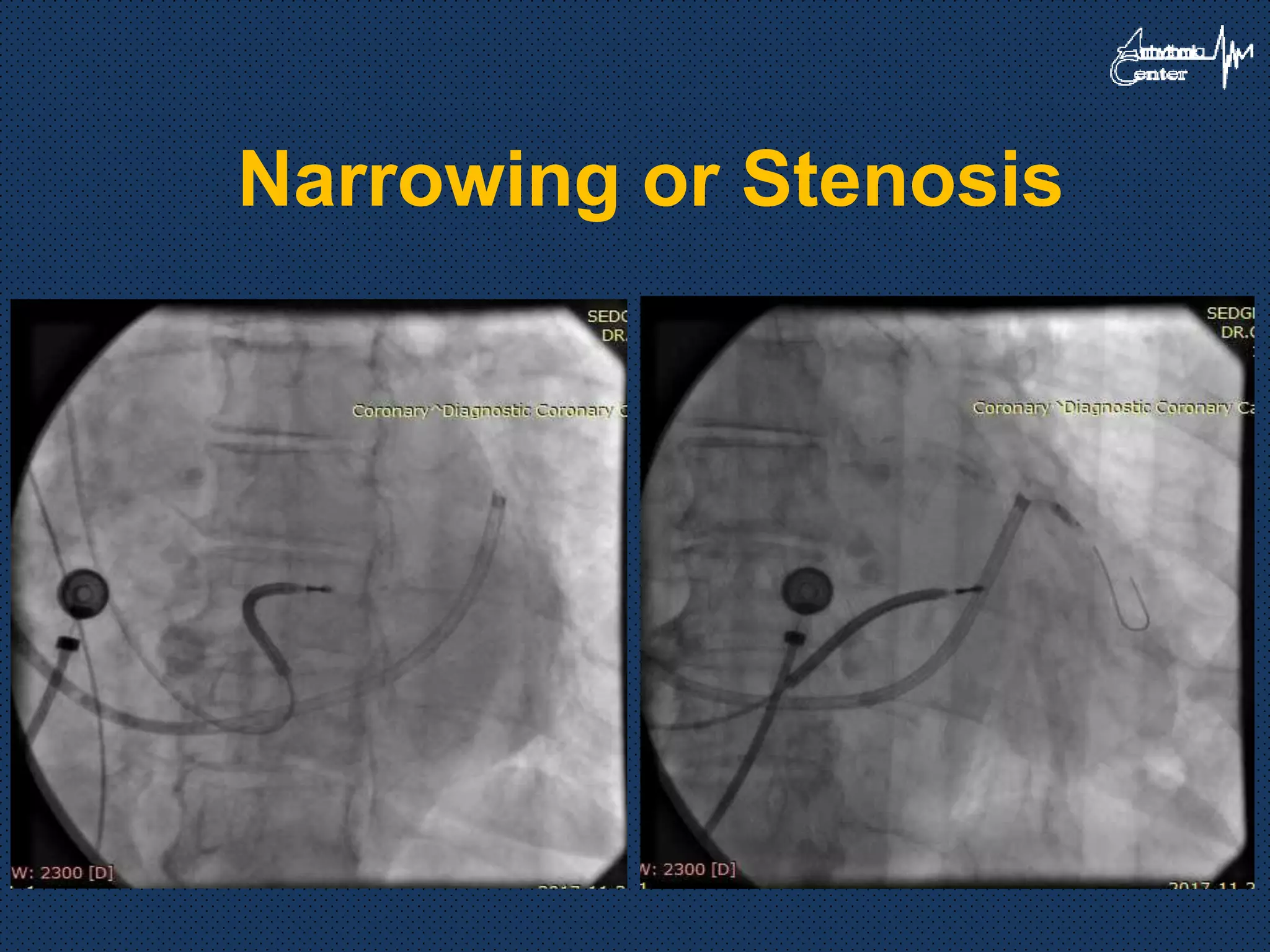 Difficult Coronary Sinus Lead Implantation | PPTX