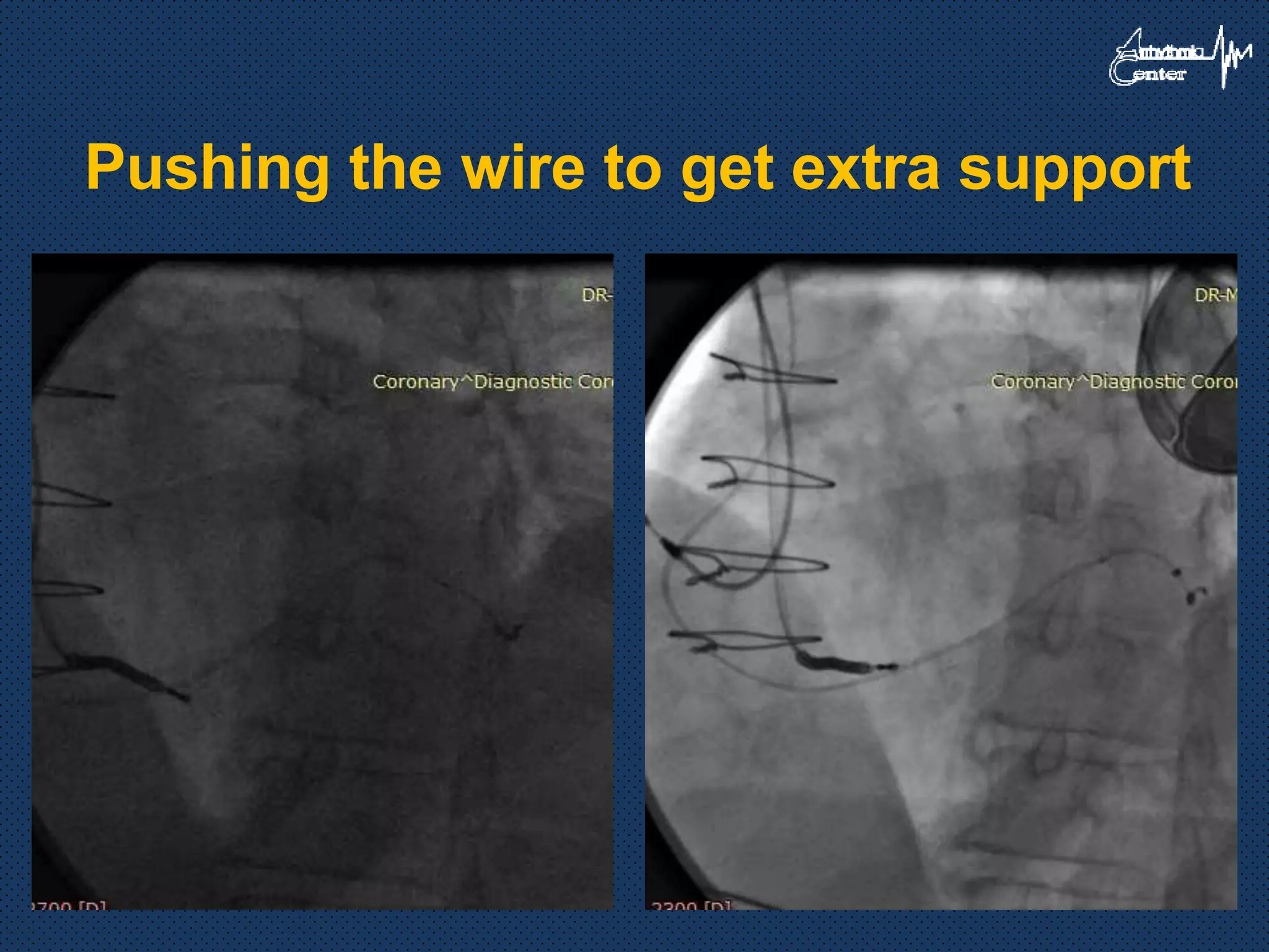 Difficult Coronary Sinus Lead Implantation | PPTX