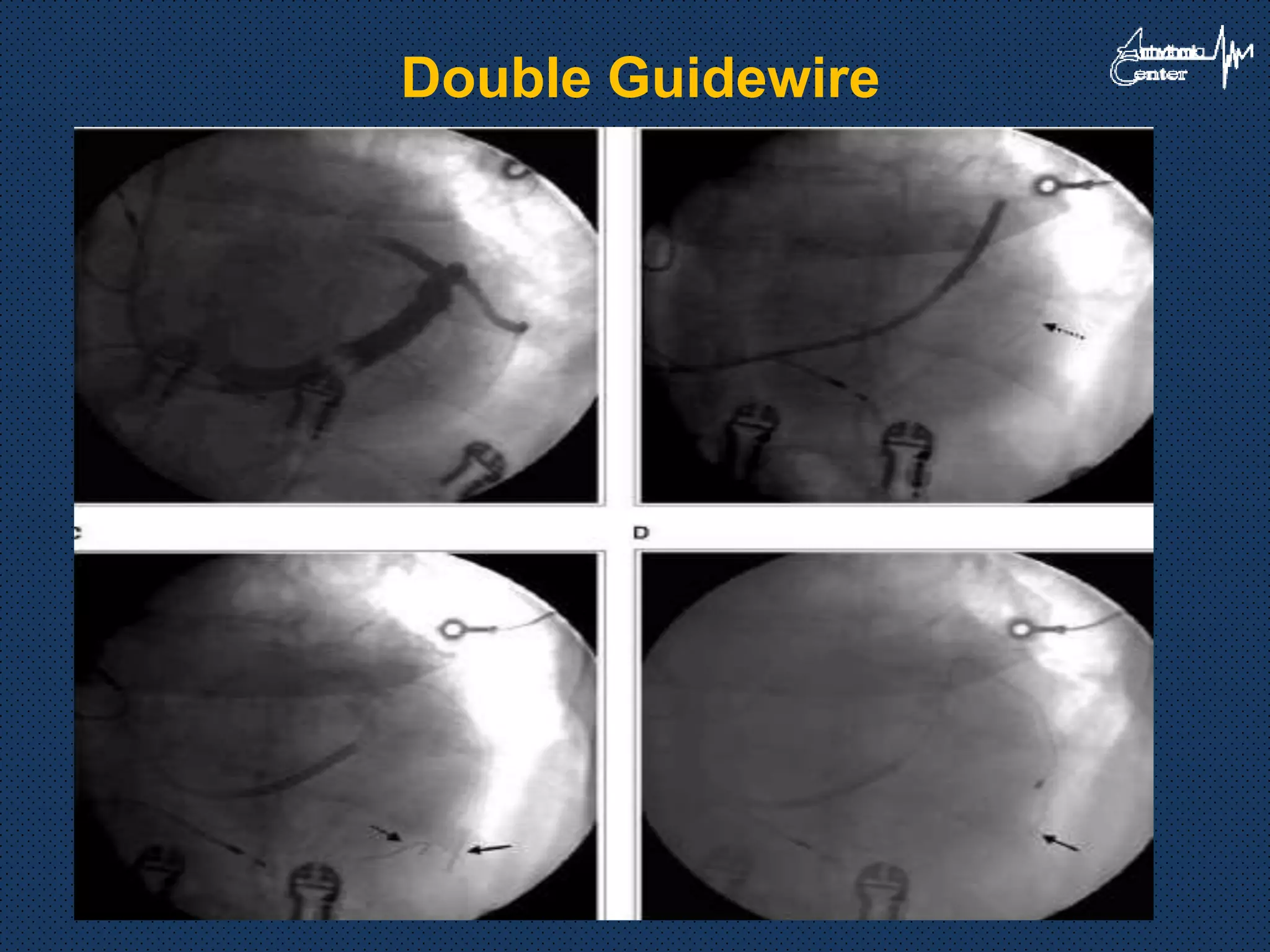 Difficult Coronary Sinus Lead Implantation | PPTX