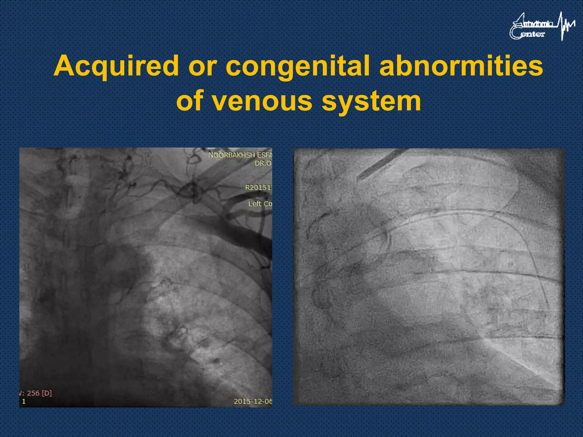 Difficult Coronary Sinus Lead Implantation | PPTX