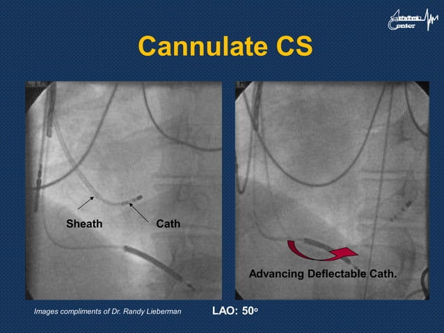 Difficult Coronary Sinus Lead Implantation | PPT