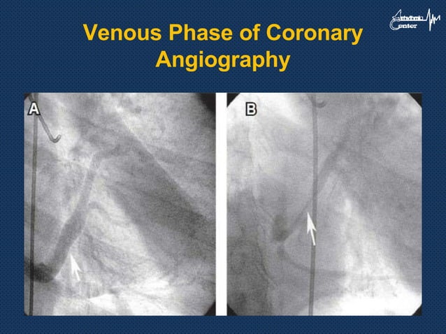 Difficult Coronary Sinus Lead Implantation | PPT