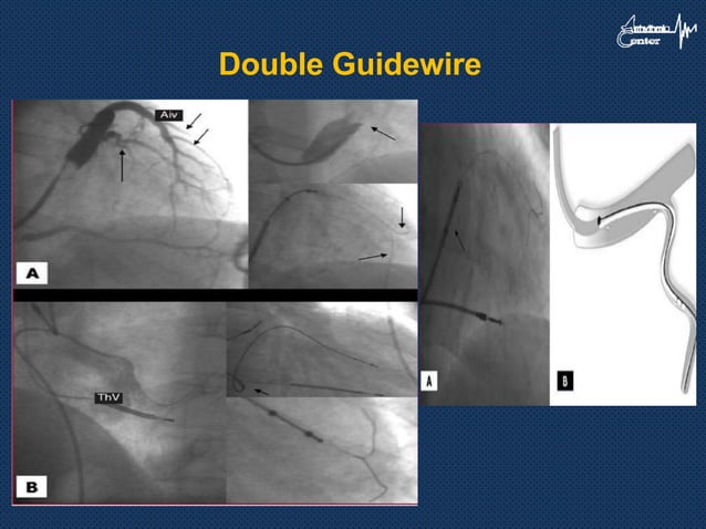 Difficult Coronary Sinus Lead Implantation | PPT