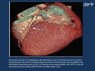 Coronary Sinus Lead