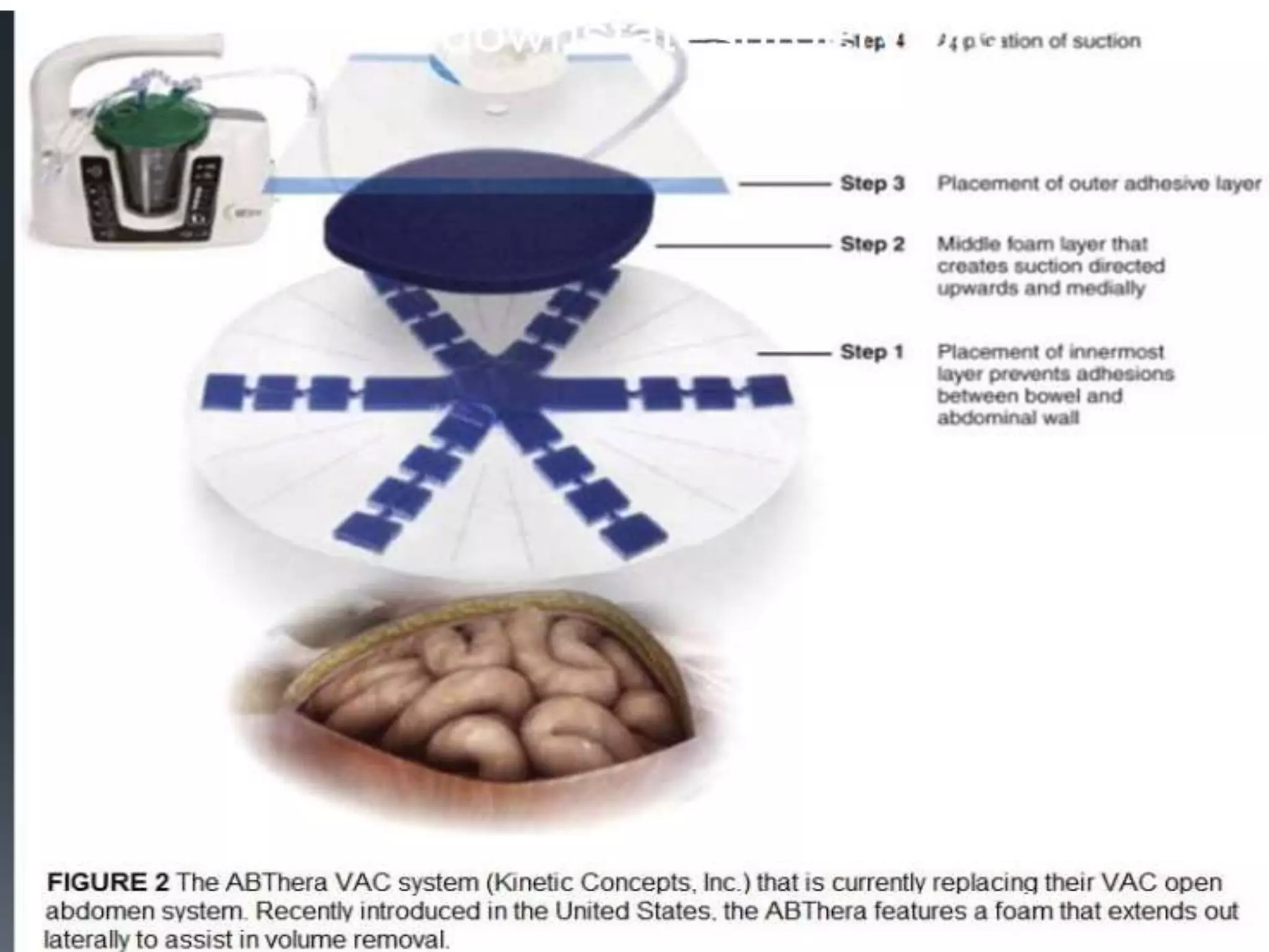 Difficult abdominal Wall | PPTX