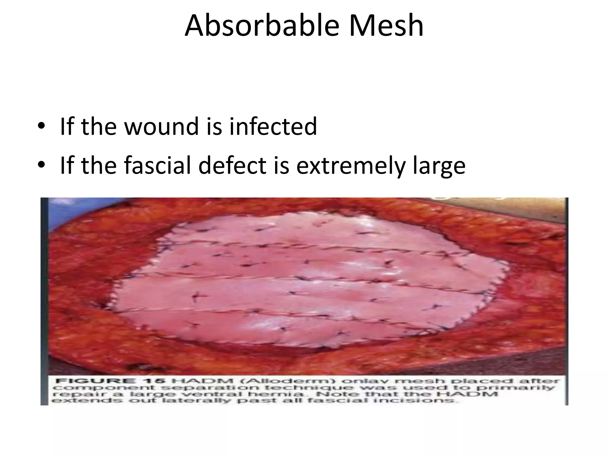 Difficult abdominal Wall | PPTX