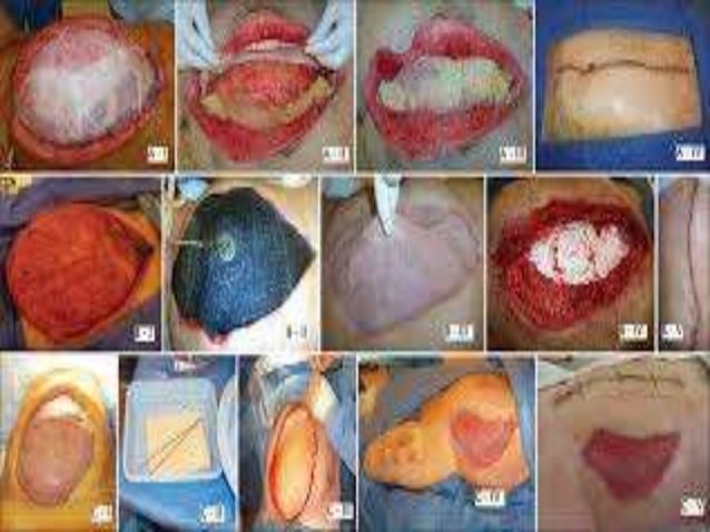 Difficult abdominal Wall | PPTX