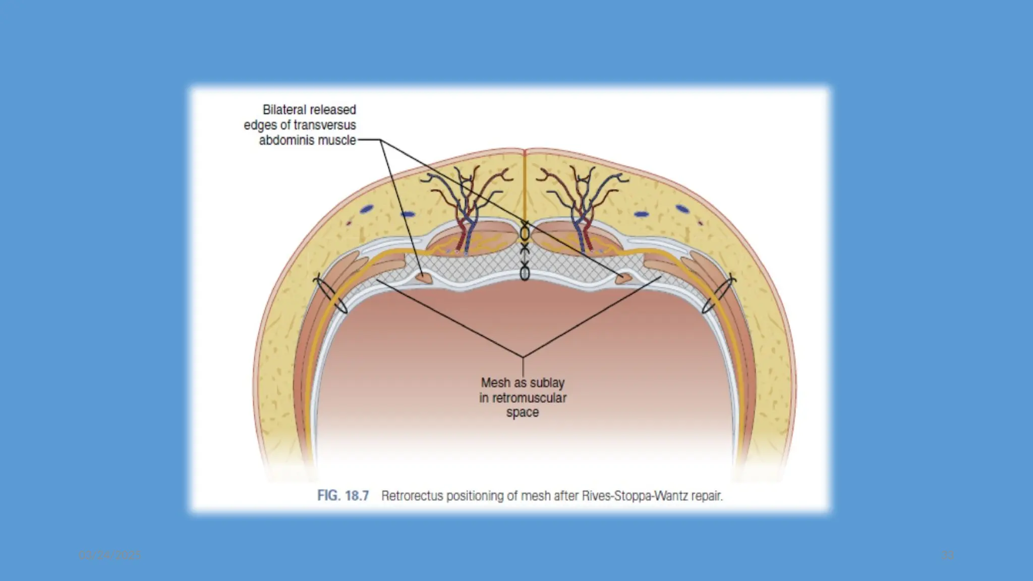 Difficult abdominal wall (sami kumar shah).pptx