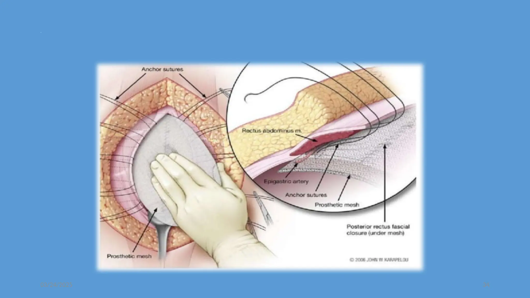 Difficult abdominal wall (sami kumar shah).pptx