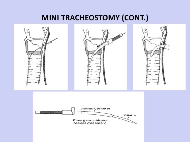 Difficult airway