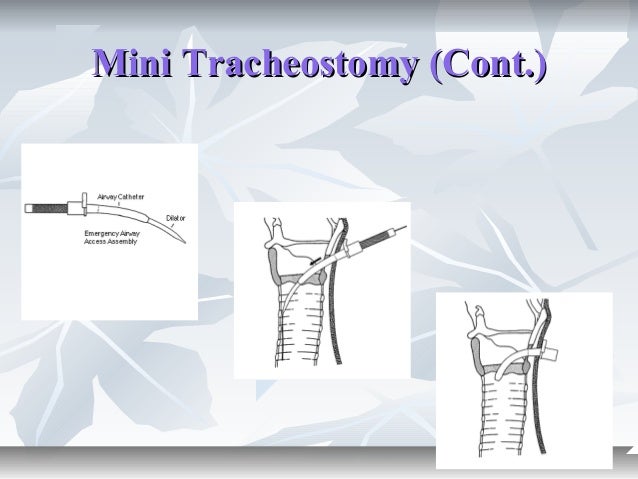 Difficult airway