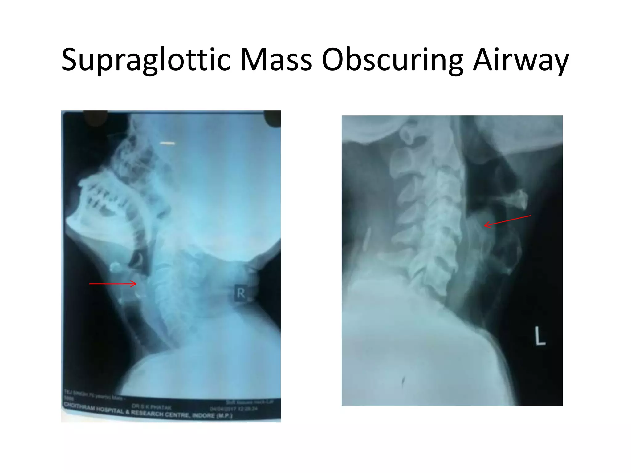 Anicipating Difficult endotracheal intubation-Xray Soft tissue neck A ...