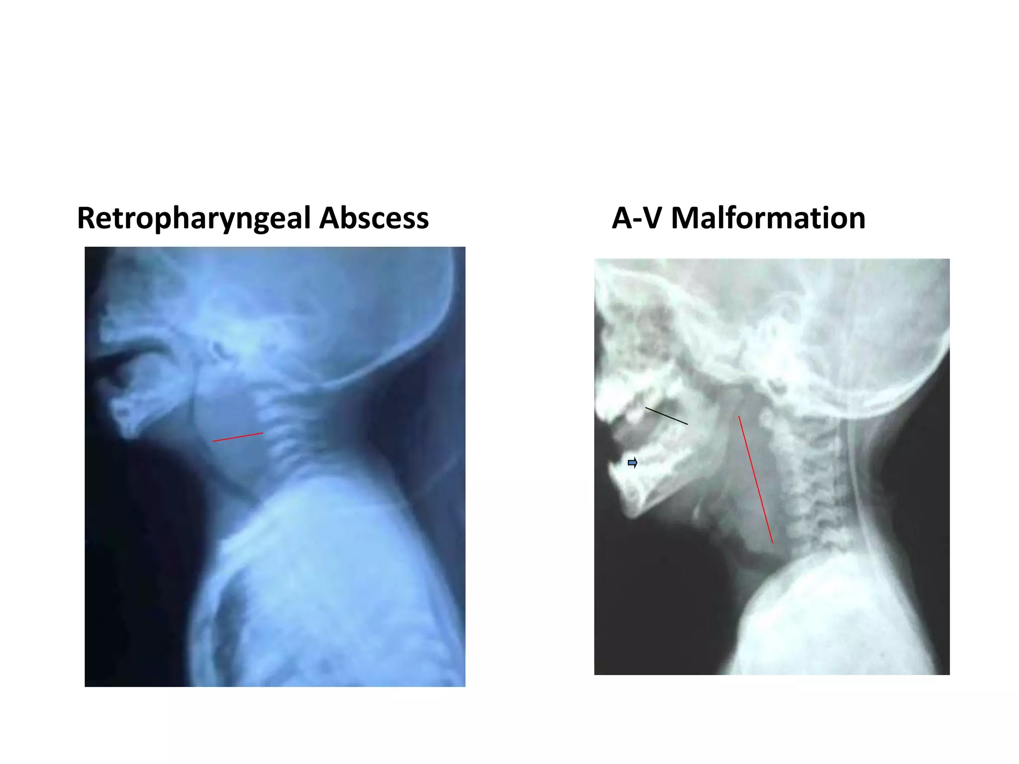 Anicipating Difficult endotracheal intubation-Xray Soft tissue neck A ...